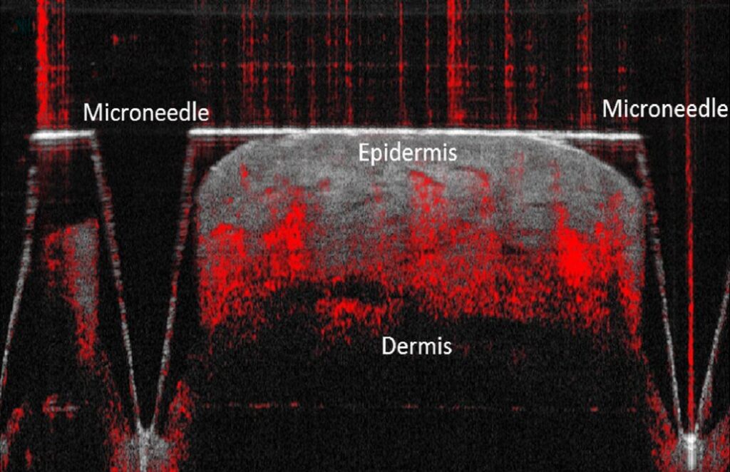 Microneedles & Transdermal Applications – VivoSight
