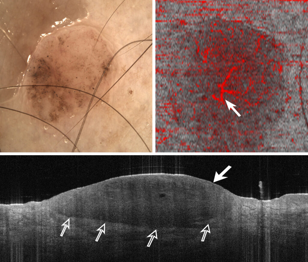 Basal Cell Carcinoma (BCC) – VivoSight