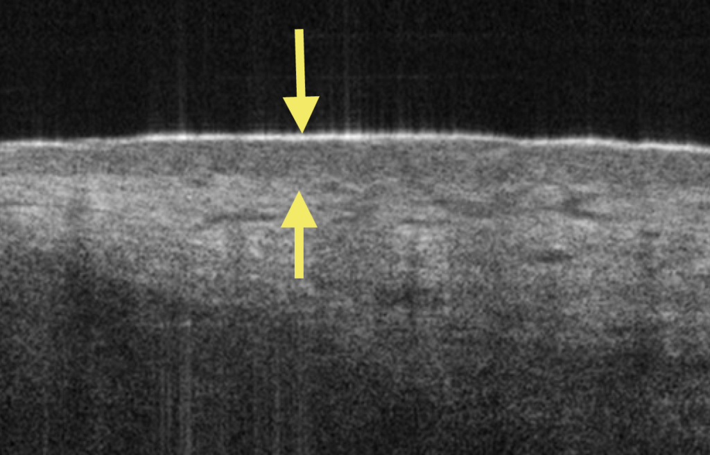 Atopic Dermatitis & Contact Dermatitis – VivoSight