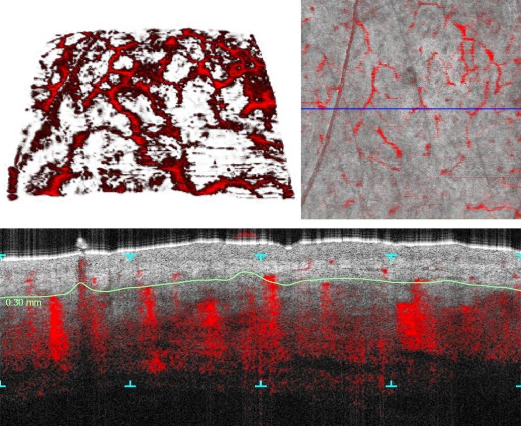 Microneedle Array Patch (MAP) Impact on Vascular Perfusion – VivoSight