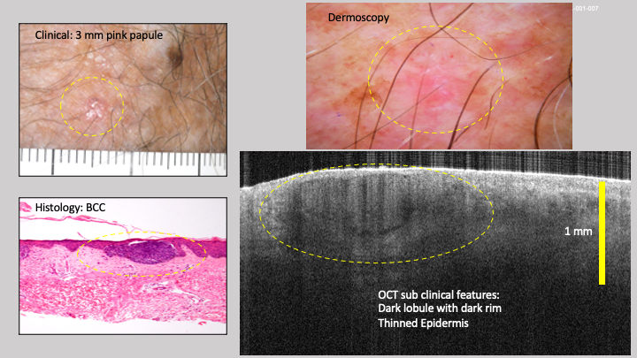 VivoSight Dx in Clinical Practice – VivoSight